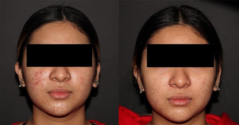 Treatments for Skin of Colour Vancouver