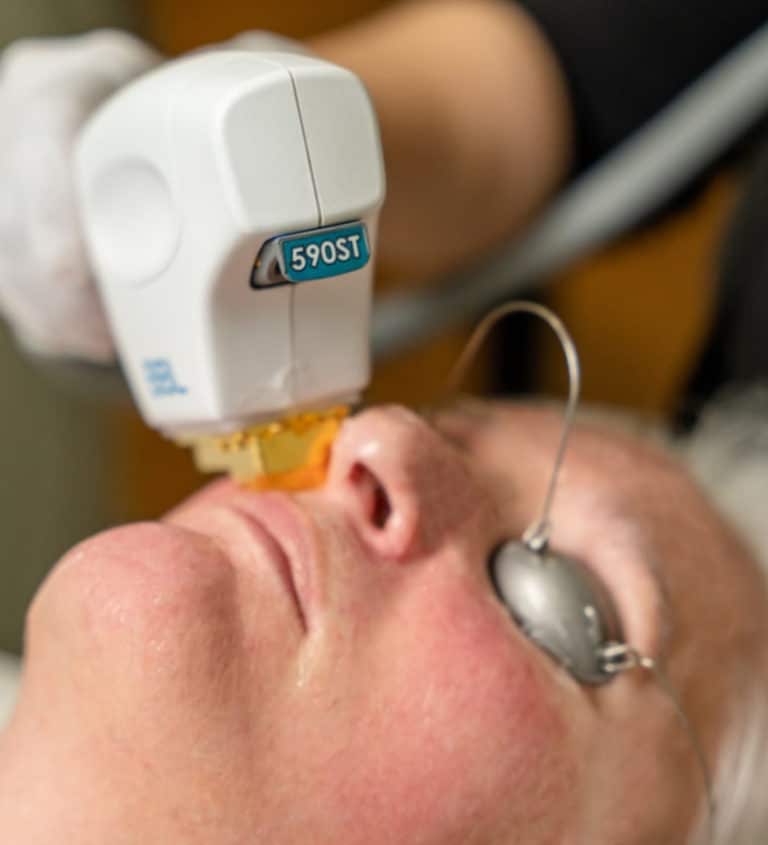 SkinTyte™ Skin Tightening Treatment | Serving Vancouver & Surrey