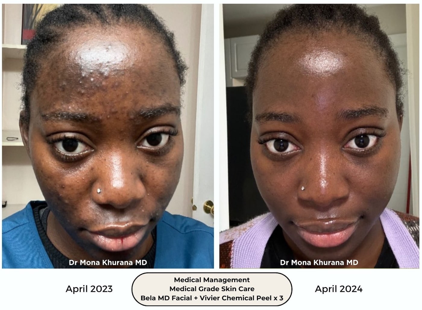 Acne Scarring | Vancouver | Treatment | Solutions | Lasers