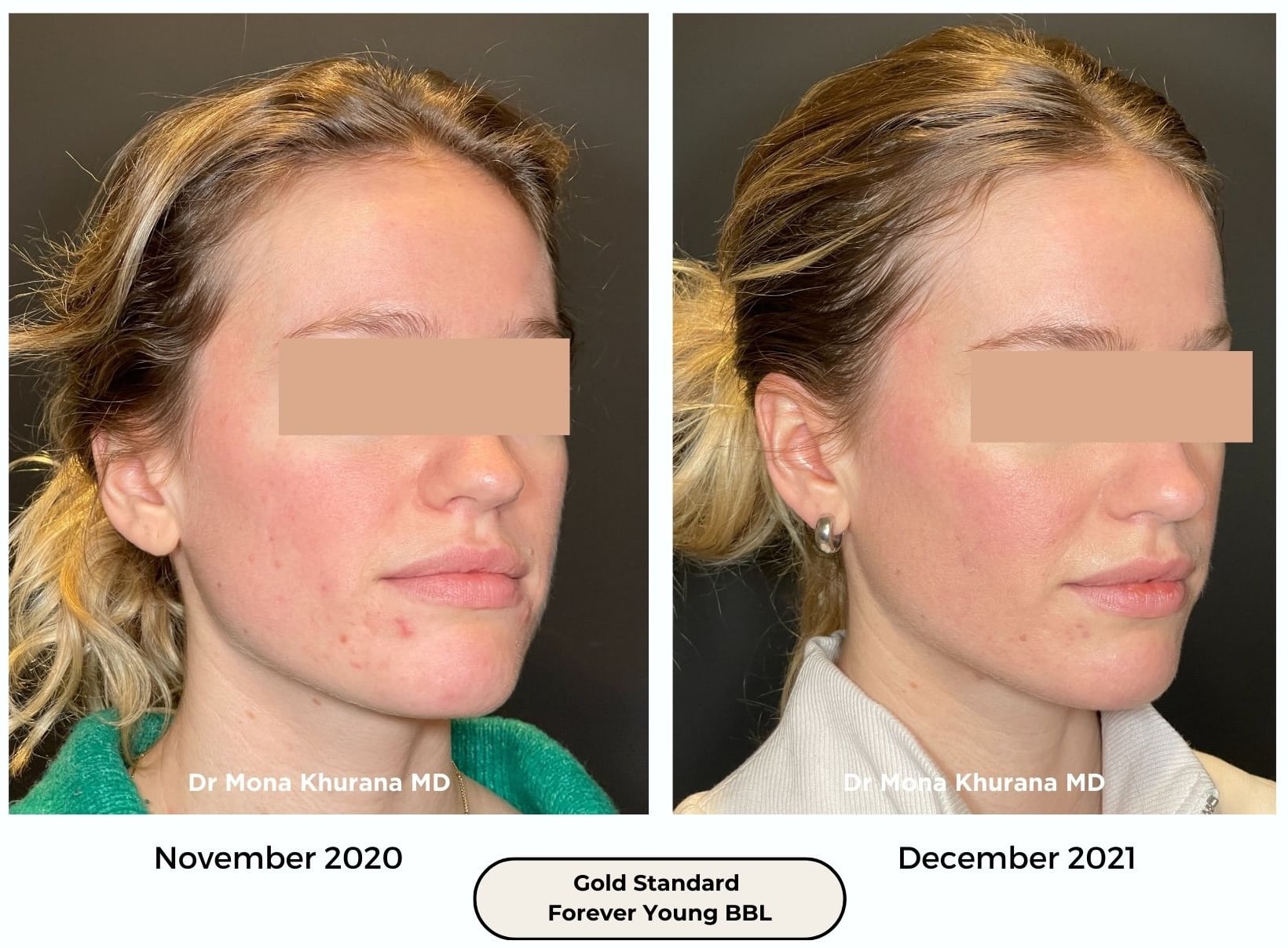Acne Scarring | Vancouver | Treatment | Solutions | Lasers