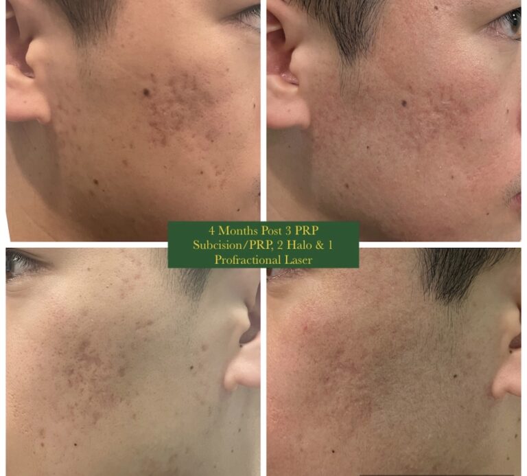 Acne Scarring | Vancouver | Treatment | Solutions | Lasers