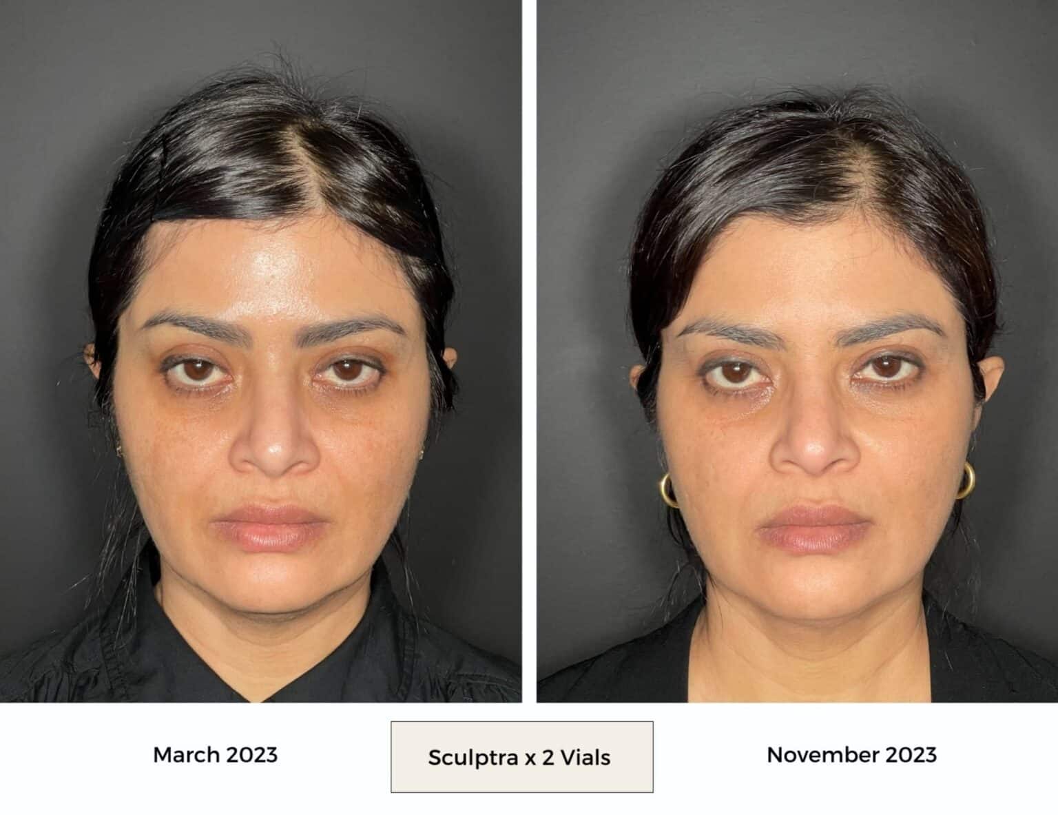 Sculptra Vancouver - Shine MD