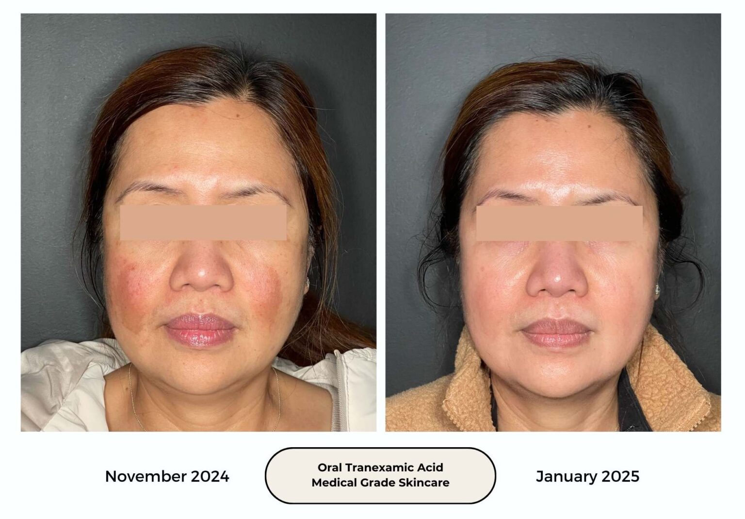 Melasma Affects All Skin Types: Safe and Effective Solutions