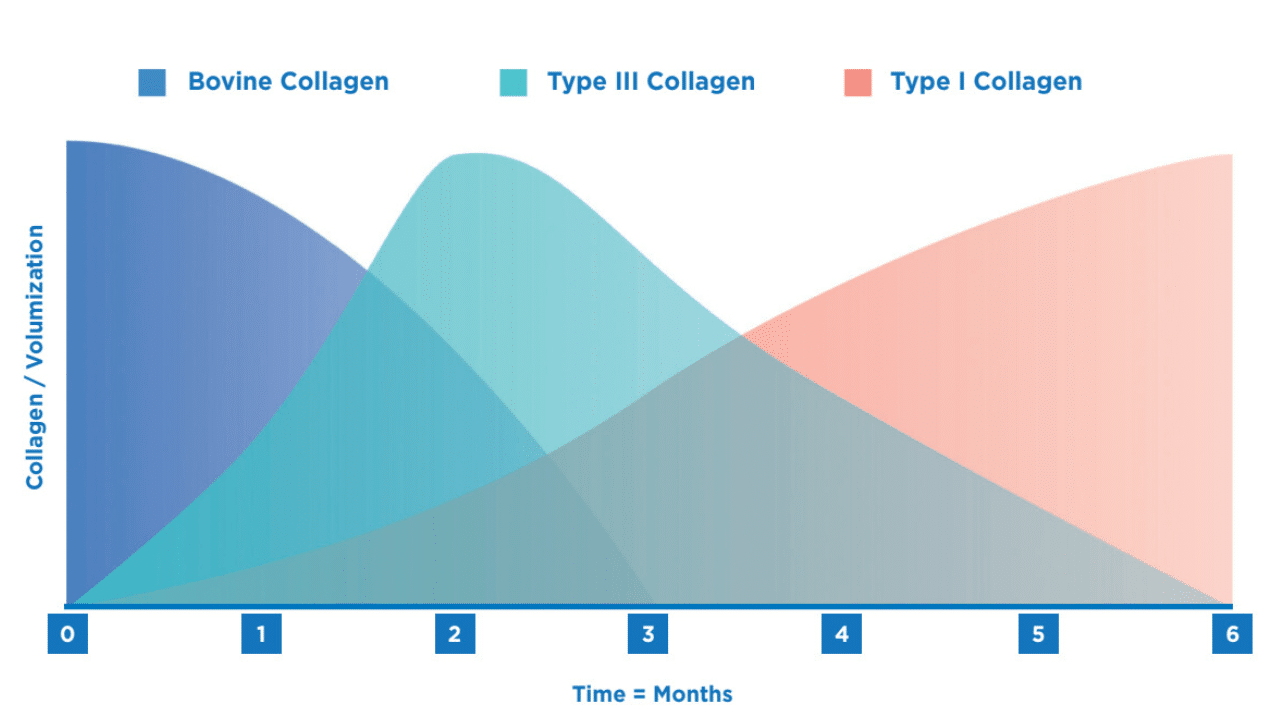 Bellafill® Acne Scar Treatment in Vancouver