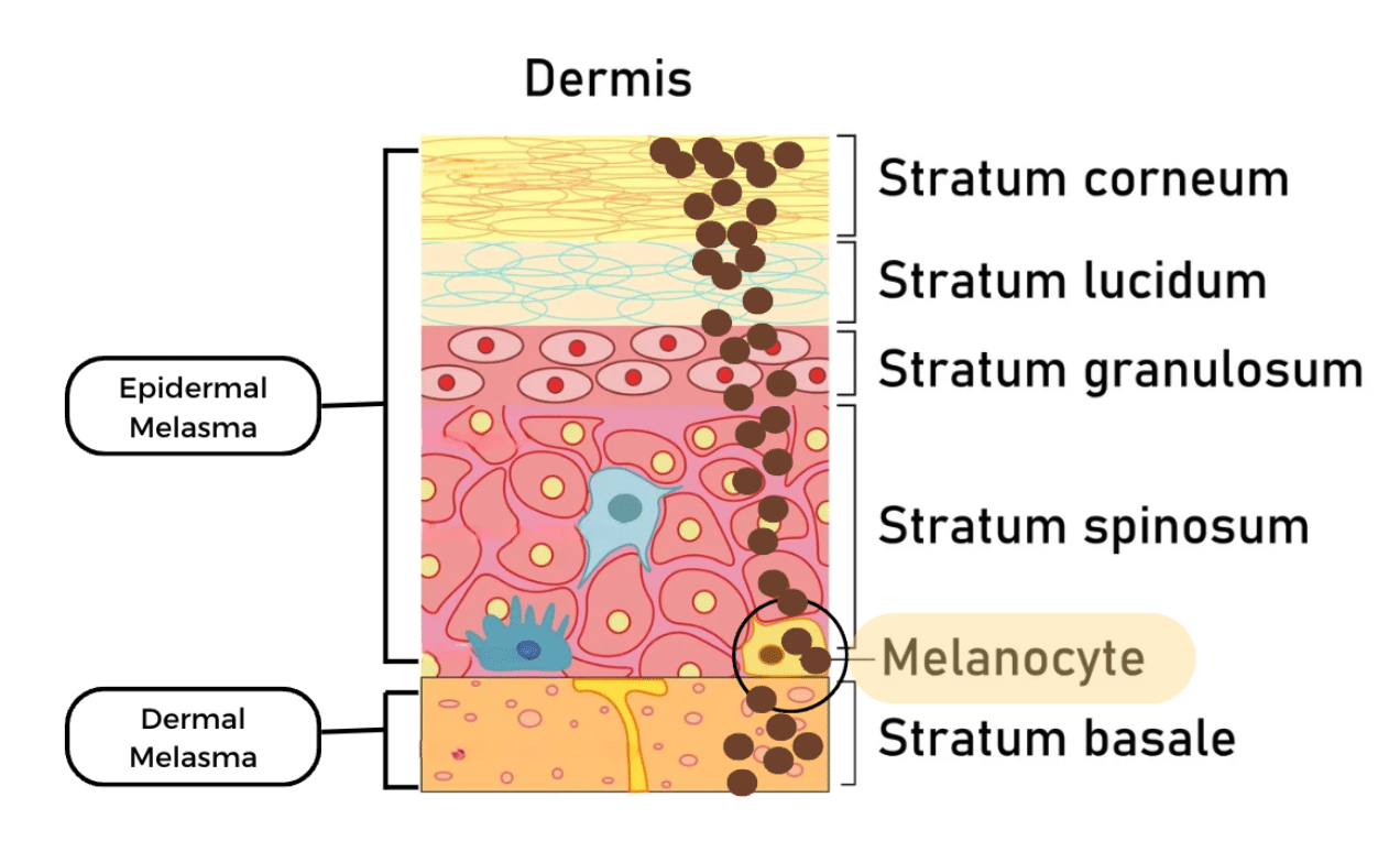 Melasma Affects All Skin Types: Safe and Effective Solutions